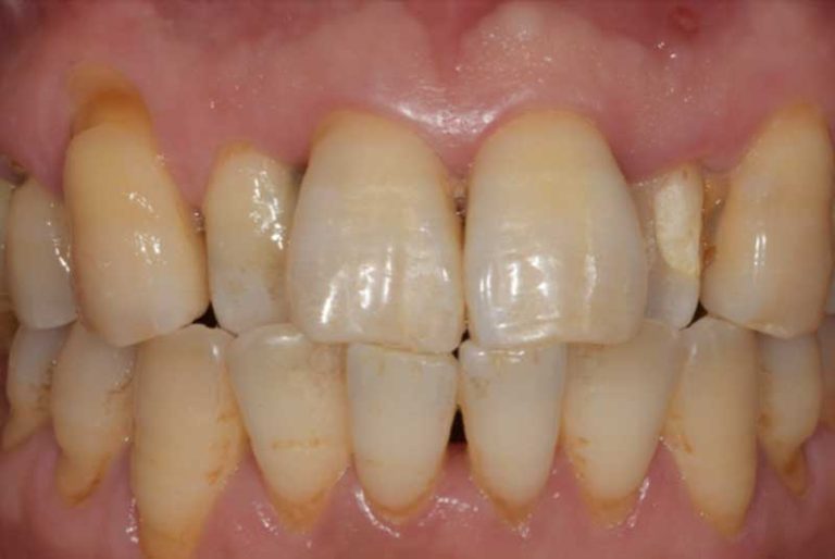 Smile Transformations | Before & After Photos | J.P Prosthodontics ...