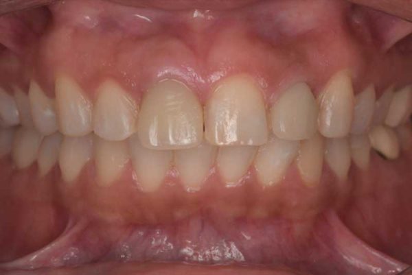 Smile Transformations | Before & After Photos | J.P Prosthodontics ...