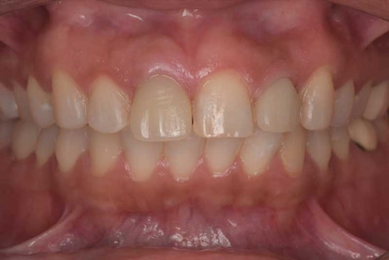 Smile Transformations | Before & After Photos | J.P Prosthodontics ...