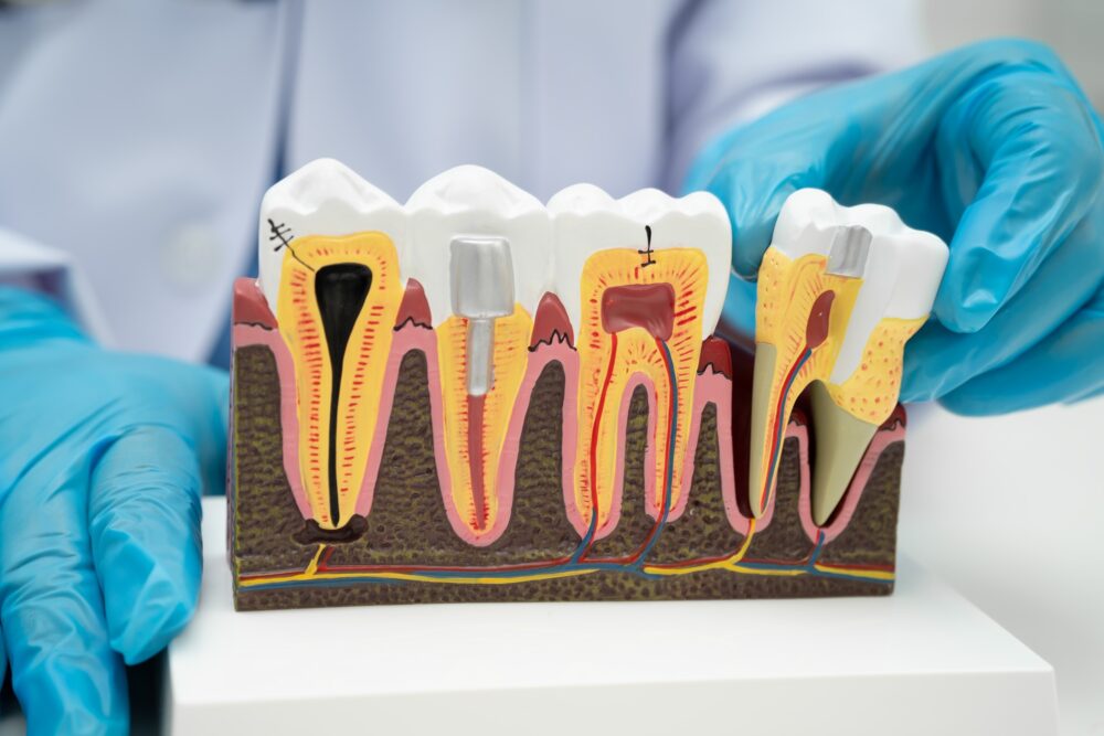 What Happens If You Delay Replacing a Missing Tooth? | Fullerton, CA